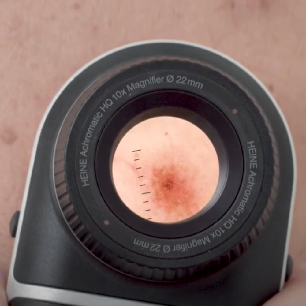 Dermatoscopio Heine DeltaOne: La herramienta indispensable para los ...