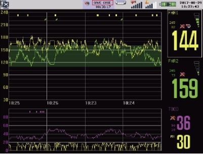 Cardiotocógrafo monitor fetal Comen C11 + VCT